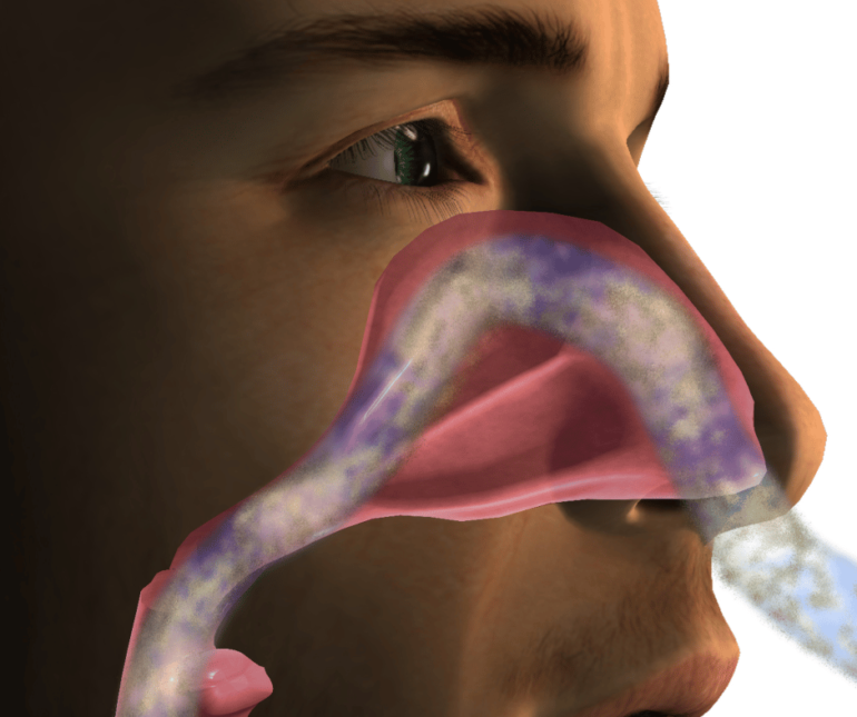 Nasal polyps: Symptoms, diagnosis, and treatment options - drvivekpathak